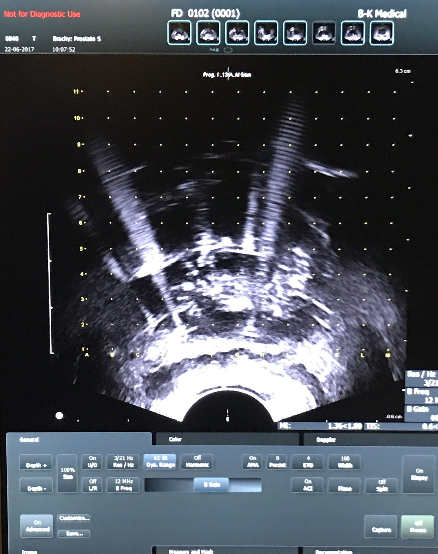 Technology – SpectraCure’s IDOSE® dose planning plattform has the ...